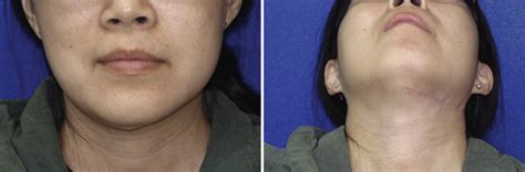 Submental Lymph Node