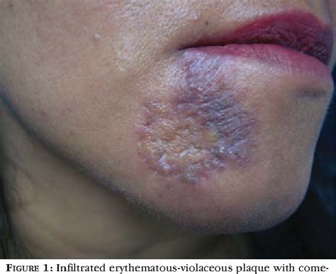 Discoid Lupus Scars