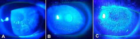 Severity Classification And Treatment Of Dry Eye Disease Opth