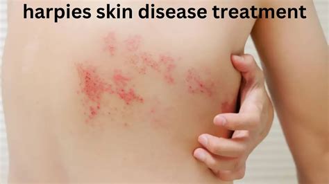 Comprehensive Guide To Harpies Skin Disease Treatment Dr Hanan