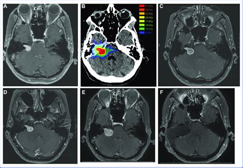 Llustrative Case Of Microsurgical Resection Following Radiation Therapy