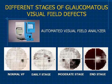 Glaucoma And Pregnancy Historical Aspects The Glaucoma