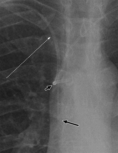 Catheter In Azygos Vein At Carolyn Wilson Blog