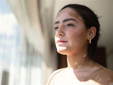 Vitiligo And Thyroid Disease Is There An Autoimmune Link