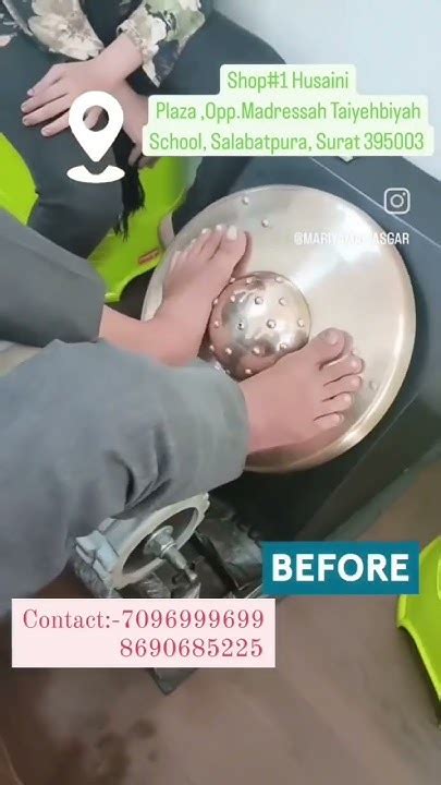 Ayurvedik Kasyakansa Thali Foot Massge Machine Center Surat Foot