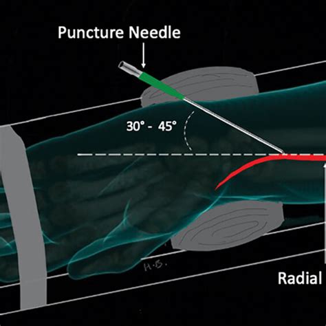Diagrammatic Representation Of The Positioning Of The Wrist And Needle