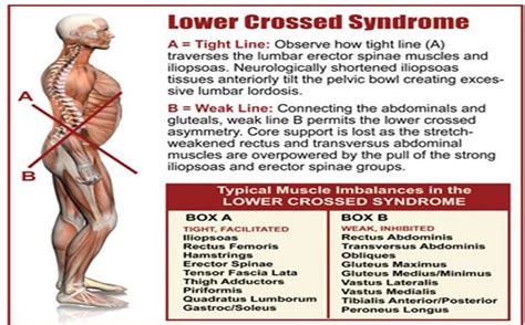 Pelvic Crossed Syndrome Janda Lower Crossed Stufy Syndrome Medical