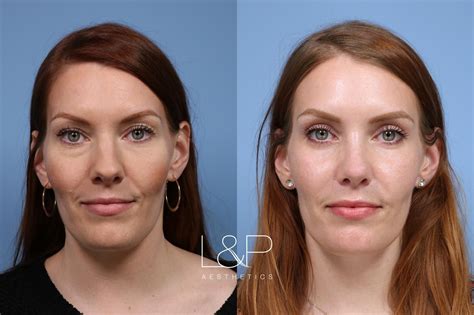 Laser Resurfacing Trl Before And After Landp Aesthetics