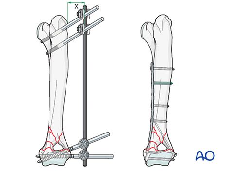 General Considerations On External Skeletal Fixators