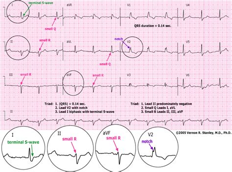 Rbbb Vs Lbbb A Systematic Review