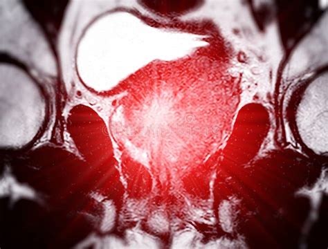 Mri Of The Prostate Gland Reveals A Focal Abnormal Signal Intensity Si