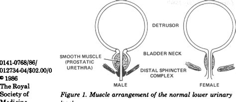 Figure 1 From Management Of Urinary Outflow Obstruction After Pelvic
