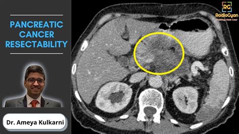 Pancreatic Cancer Resectability What Radiologists Need To Know Youtube