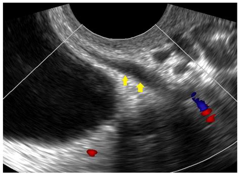Transvaginal Ultrasound In The Diagnosis And Assessment Of