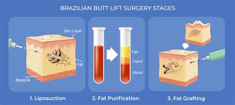 10 Things You Need To Know About Brazilian ‌‌butt Lift Mcan Health Blog