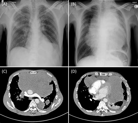 Thoracic Smarca4‐deficient Undifferentiated Tumour Diagnostic Challenges And Potential For