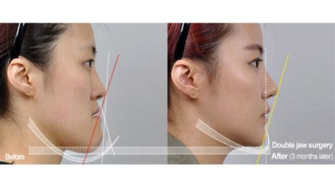 Benefits Of Double Jaw Surgery Double Jaw Surgery Wiyoi