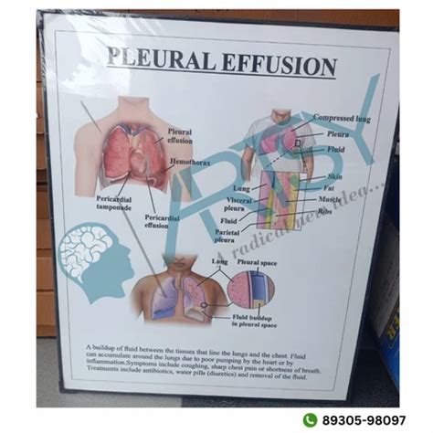 Artsy Pleural Effussion Chart Size 20x24 Inch At Rs 950piece In