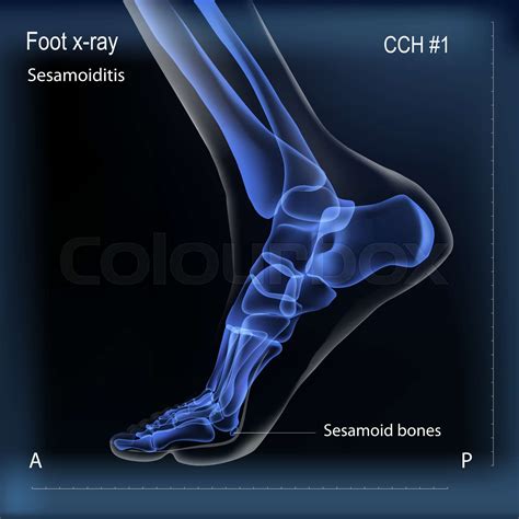 Sesamoiditis X Ray