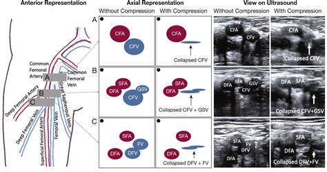 Point Of Care Ultrasound For Bedside Diagnosis Of Lower Extremity Dvt