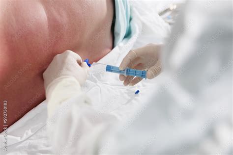 Epidural Anesthesia Injection For Spinal Anesthesia Nerve Blockage An Anesthesiologist At Work