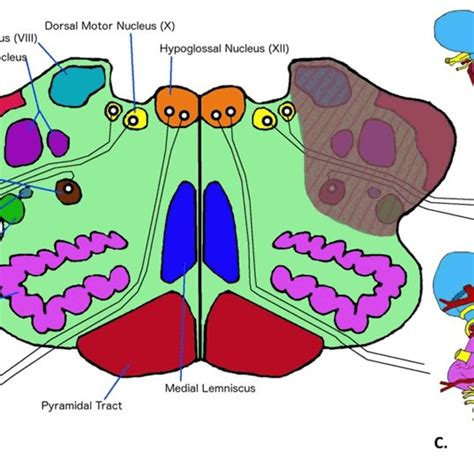 Structures Affected In Medial Medullary Syndrome A Transverse View Of
