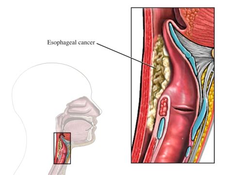 Esophageal Cancer Symptoms City Of Hope California