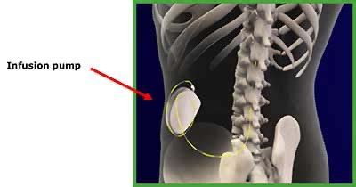 Intrathecal Drug Delivery Systems South Tees Hospitals Nhs Foundation