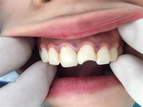 前牙美学树脂导板修复 医联