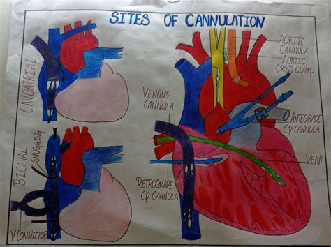 Perfusion Cannulation Perfusionist Deepika V