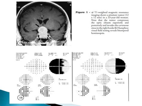 Trans Sphenoid Hypophysectomy Pptx