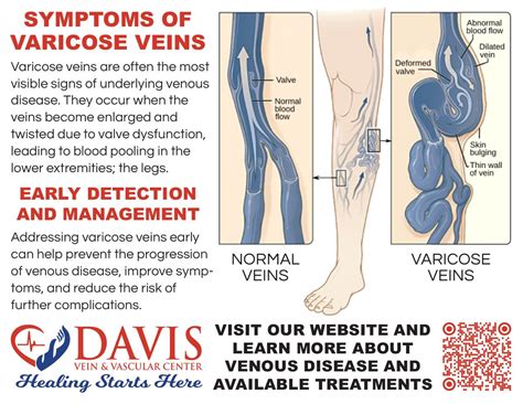 Venousdisease Symptomrelief Davisveinandvascular