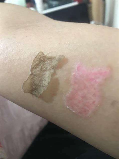 Laser Tattoo Removal On Red Ink R Peeling