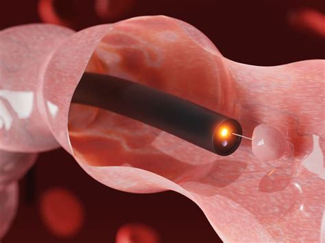 Un Polype Peut Il Partir Tout Seul Ya Quoi La