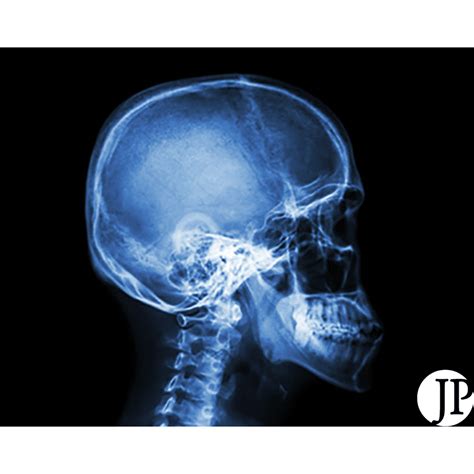 What Is The Eggshell Skull Rule Paradowski Law