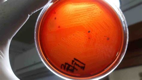 Alerta Por Casos De Streptococcus Pyogenes Una Enfermedad Invasiva Que Afecta Sobre Todo A