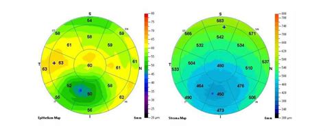 Pachymetry Contact Lenses Eye Care Orangeville