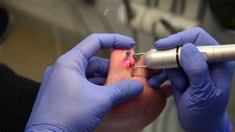 Laser Plantar Wart Removal Aftercare At Ross Brown Blog