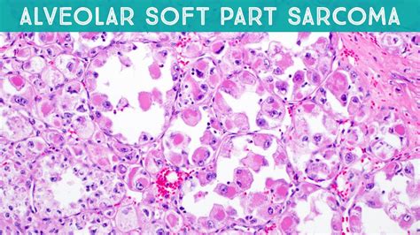 Alveolar Soft Part Sarcoma At Barbara Ridgley Blog