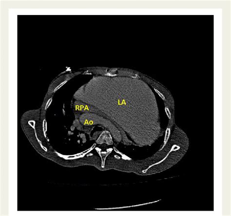 Multi Slice Computed Tomography Showing Left Atrium Compressing Right Download Scientific