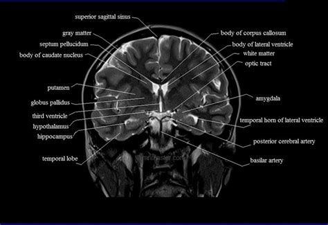 Mri Anatomy Hypothalamus At Layla Odilia Blog
