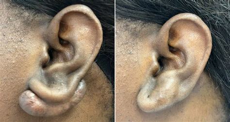 Navel Keloid Removal At Chloe Chauvel Blog