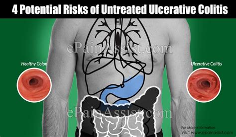 4 Potential Risks Of Untreated Ulcerative Colitis