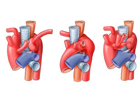 Vascular Ring Dysphagia At Andrea Mcclelland Blog