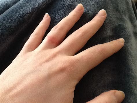 Wedding Ring Finger Rash Skincare Hacks For Contact Dermatitis Relief