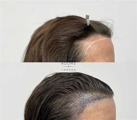 Hair Transplant Surgery Archives Treatment Rooms London