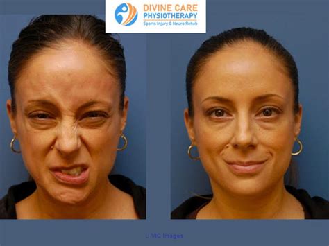 Neurological Physiotherapy All Care Physio Bppv Langley Physioth