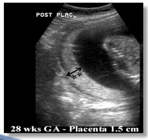 Lecture 7 Placental Variants And Abnormalities Umbilical Cord Abnormalities And Af Abnormalities