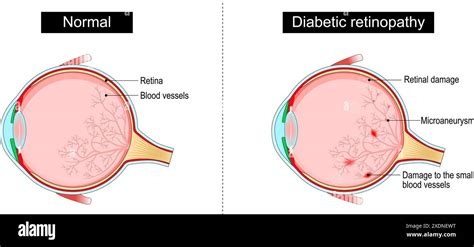 Retinopathy Retina Eye Stock Vector Images Alamy