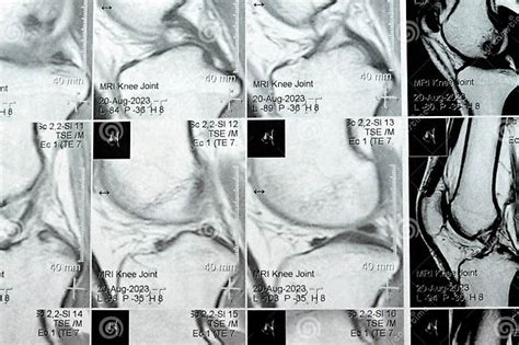 Mri Of The Right Knee Showing Mild Joint Effusion With Normal Other